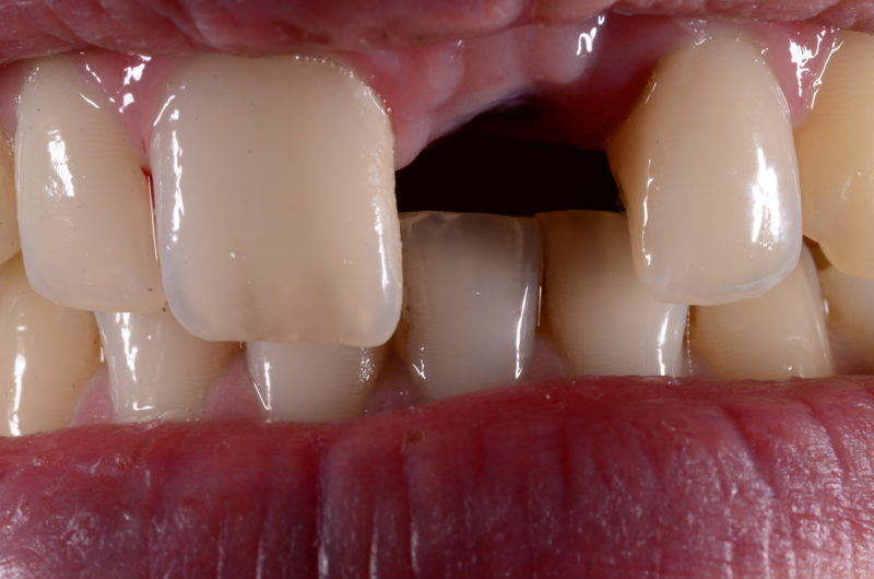 Een tandprothese laten maken bij ons - Global Smile